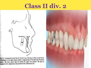 class ii division 2 malocclusion | PPTX