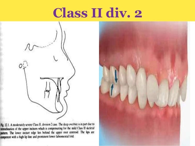 class ii division 2 malocclusion