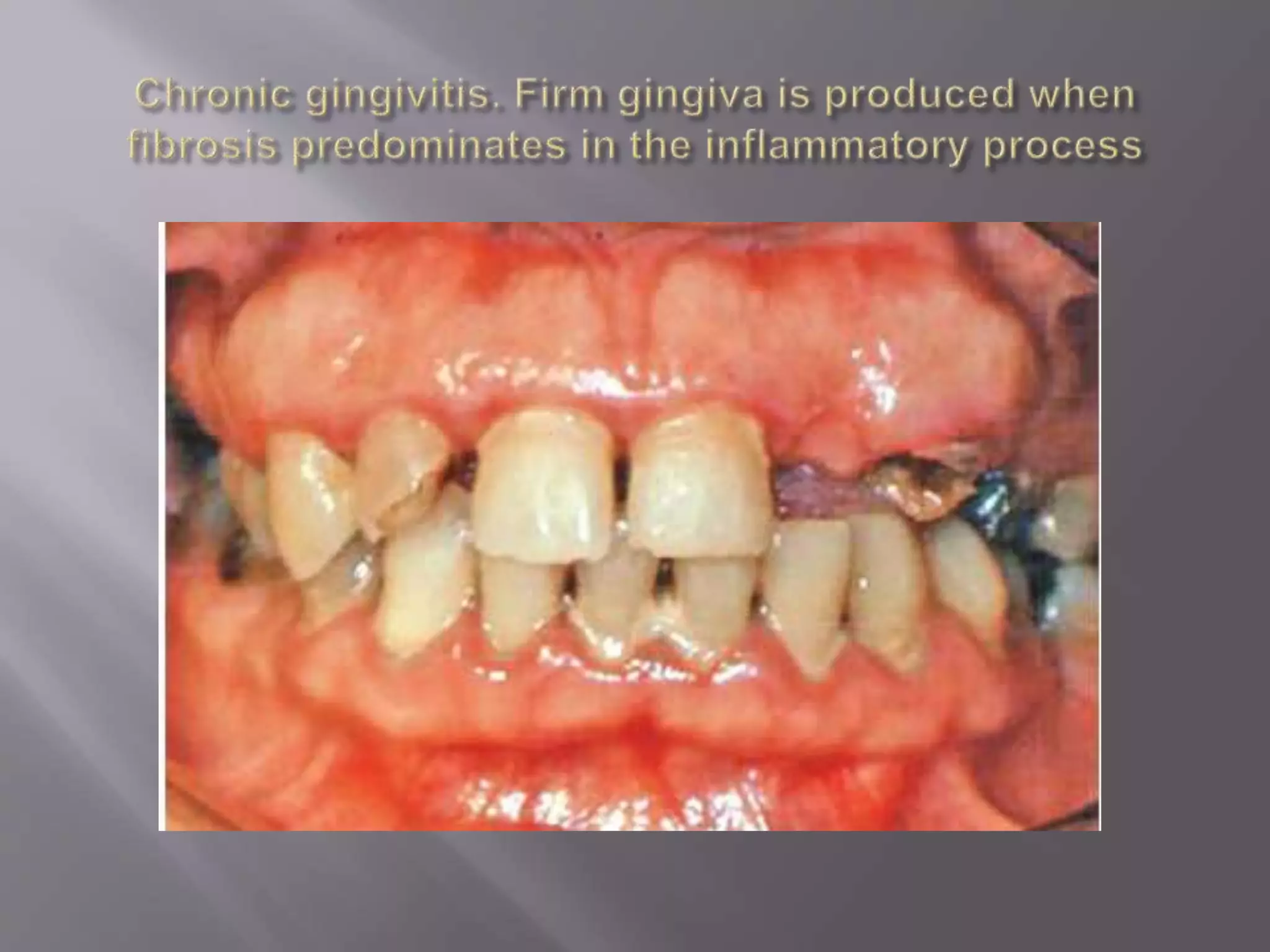 Clincial features of gingivitis | PPT