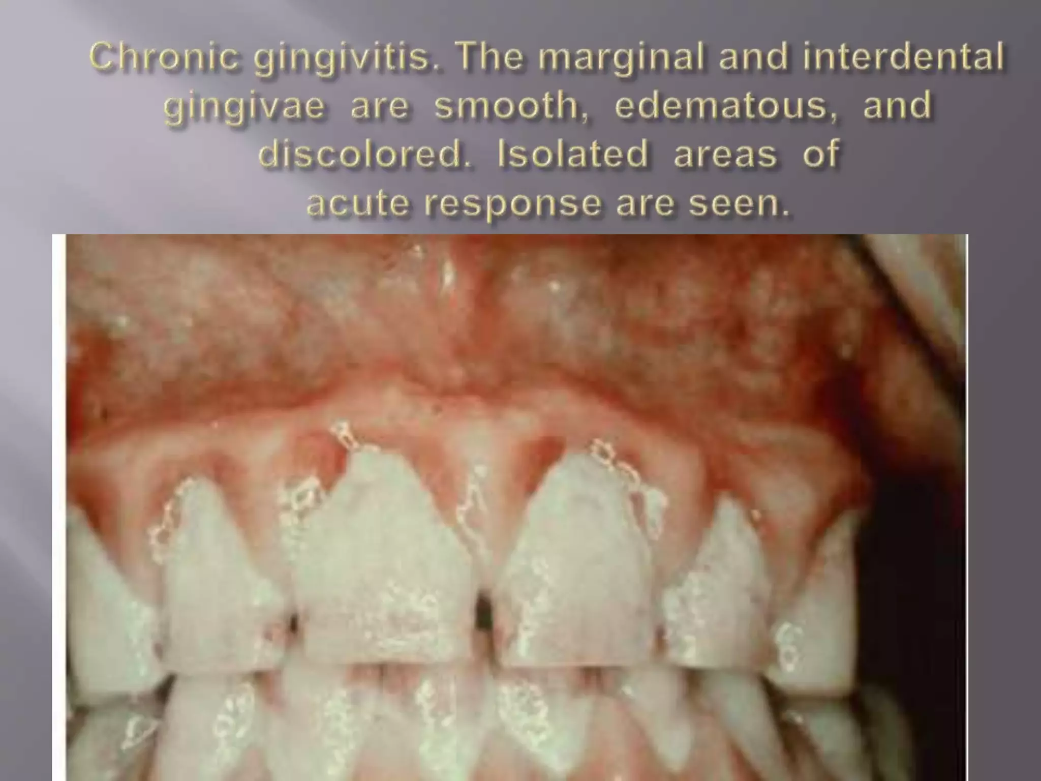 Clincial features of gingivitis | PPT