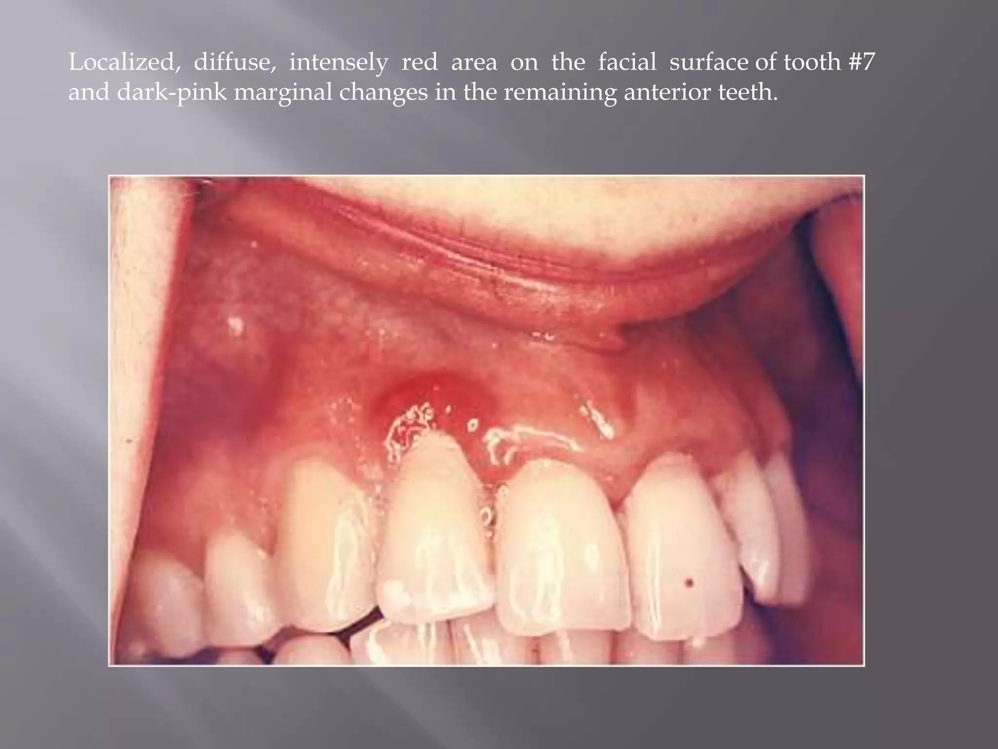Clincial features of gingivitis | PPT