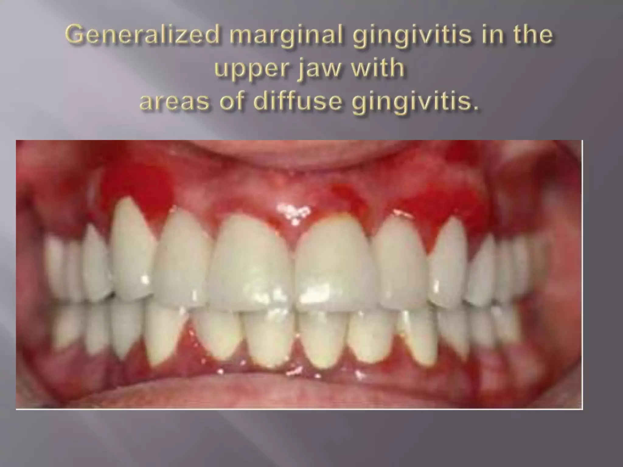 Clincial features of gingivitis | PPT