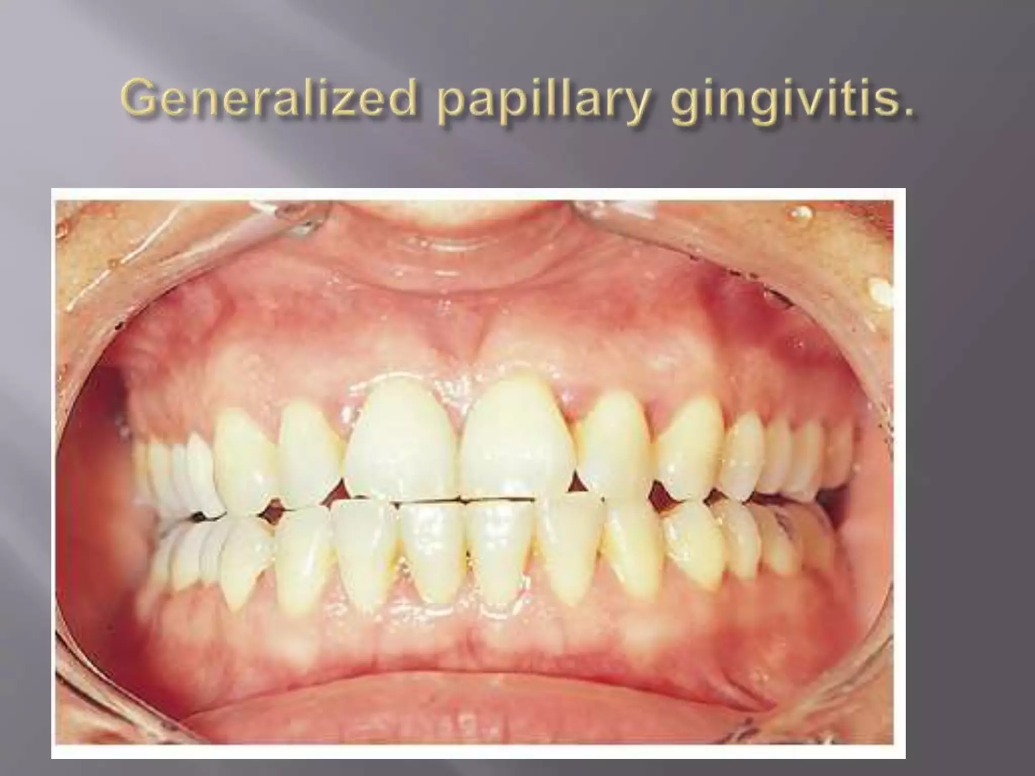 Clincial features of gingivitis | PPT