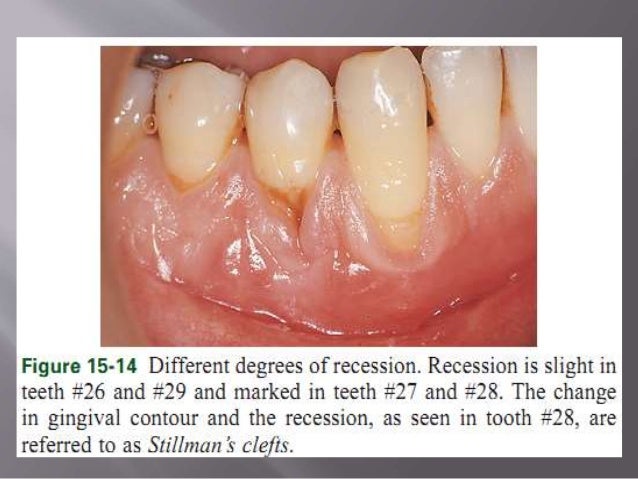 Clincial features of gingivitis