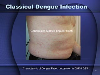 Clinial Manifestations of Dengue Fever | PPTX