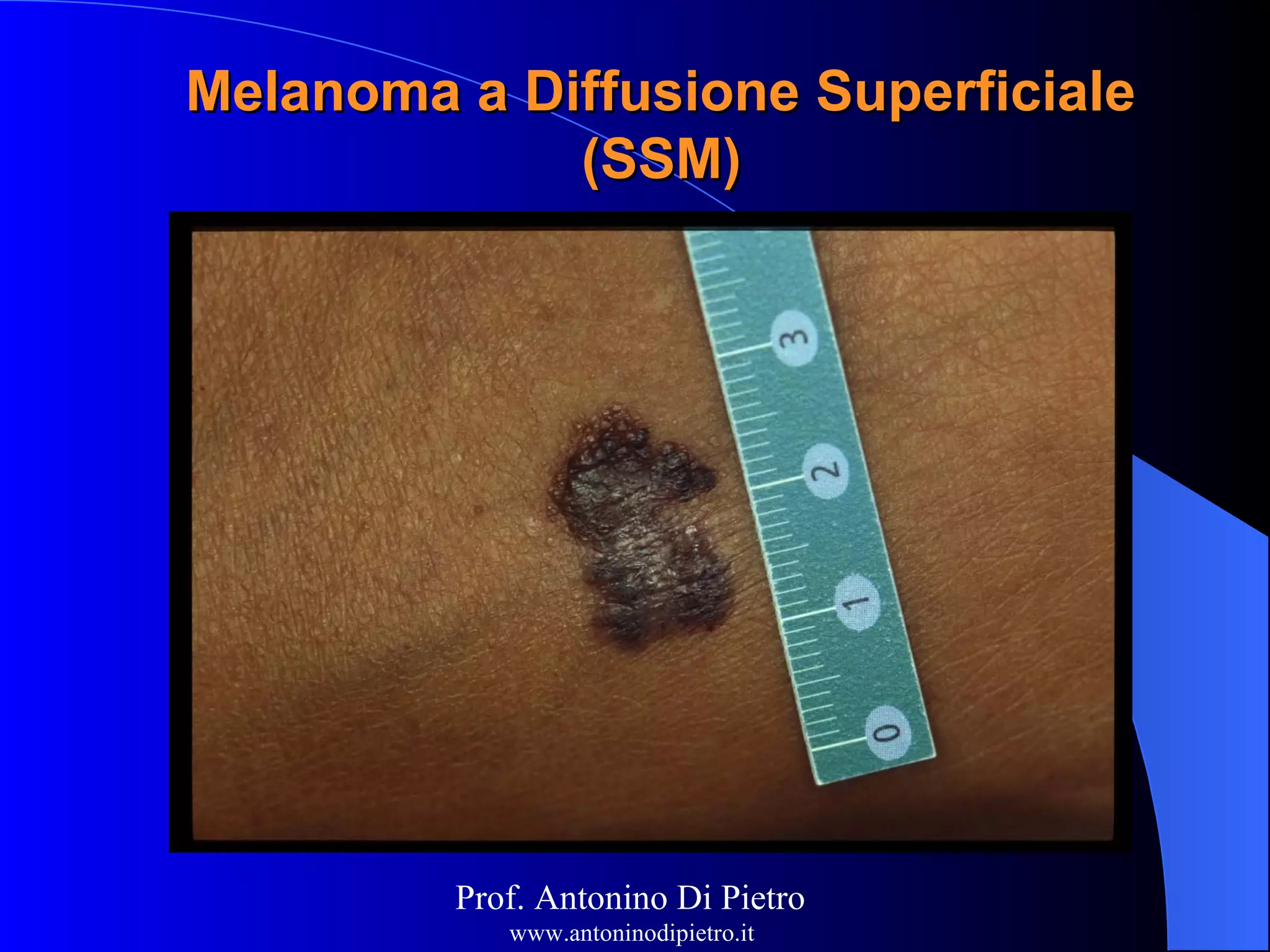 Il melanoma cutaneo: dalla clinica alla terapia | PPT