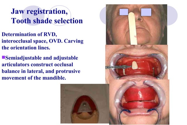 Clinical-and-laboratory-steps-of-Complete-denture.pdf | Dental Health ...