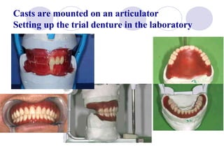 Clinical-and-laboratory-steps-of-Complete-denture.pdf