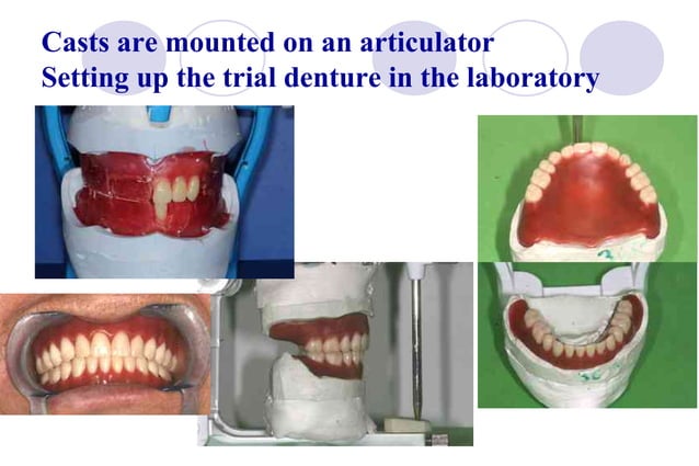 Clinical-and-laboratory-steps-of-Complete-denture.pdf | Dental Health ...
