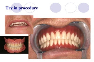 Clinical-and-laboratory-steps-of-Complete-denture.pdf