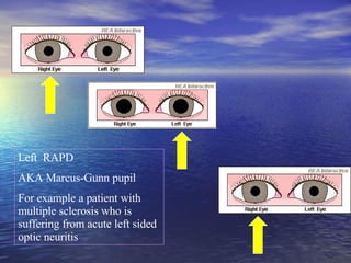 Neurological Examination Part II:-Clinical Evaluation of the Brainstem ...