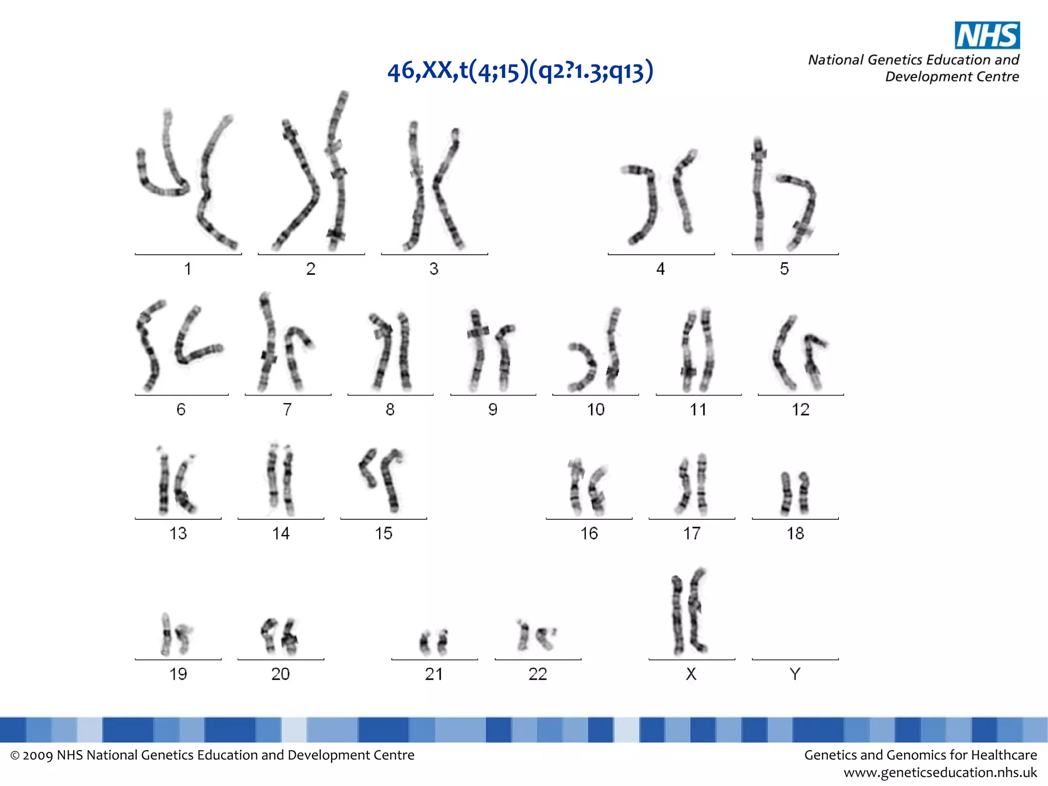 Clinical Photos - Chromosome structure abnormality | PPT