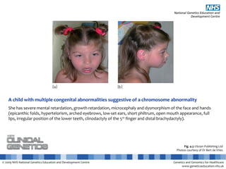 Clinical Photos - Chromosome structure abnormality | PPT