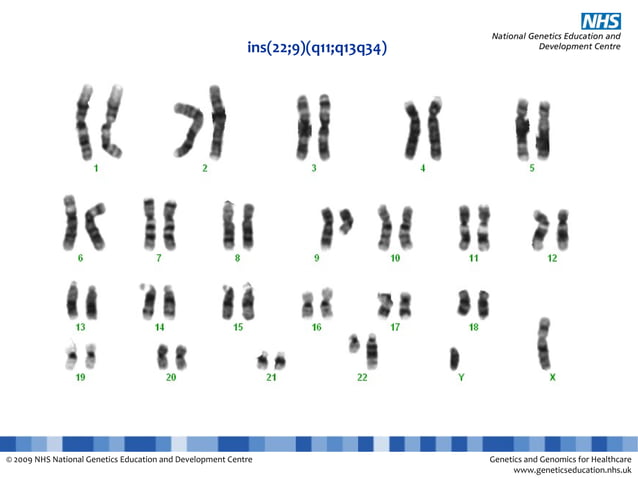 Clinical Photos - Chromosome structure abnormality | PPT