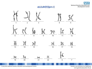 Clinical Photos - Chromosome structure abnormality | PPT