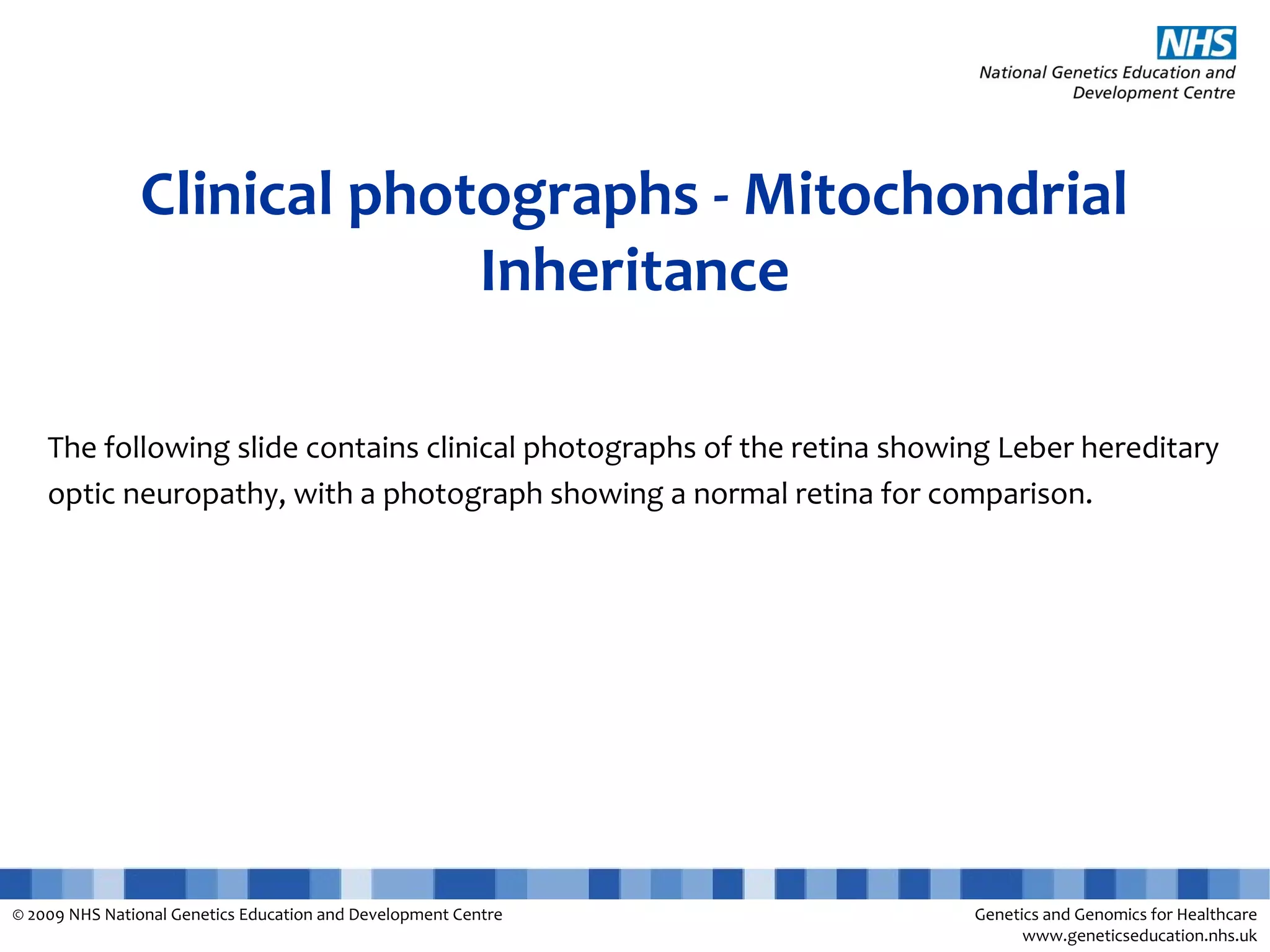 Clinical Photos: Mitochondrial inheritance | PPT