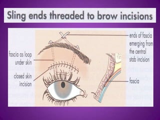 Clinical ptosis | PPTX
