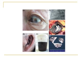 Phenylketonuria Alkaptonuria Albinism | PPT