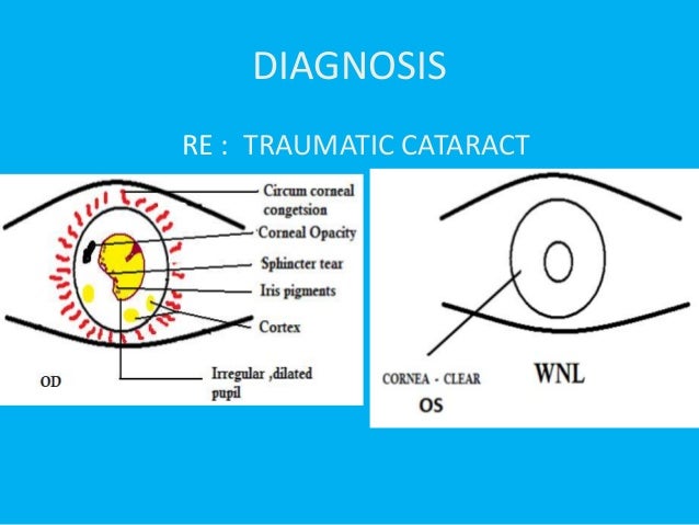 Clinical - Traumatic cataract