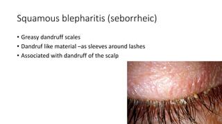 Clinical 5th Grade Dr Ahmed Osama Hashem Ophthalmology.pptx