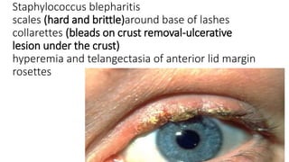 Clinical 5th Grade Dr Ahmed Osama Hashem Ophthalmology.pptx