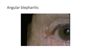 Clinical 5th Grade Dr Ahmed Osama Hashem Ophthalmology.pptx