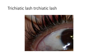 Clinical 5th Grade Dr Ahmed Osama Hashem Ophthalmology.pptx