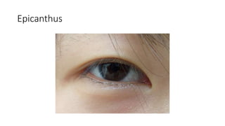 Clinical 5th Grade Dr Ahmed Osama Hashem Ophthalmology.pptx