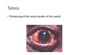 Clinical 5th Grade Dr Ahmed Osama Hashem Ophthalmology.pptx