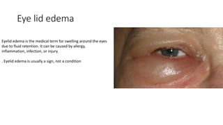 Clinical 5th Grade Dr Ahmed Osama Hashem Ophthalmology.pptx