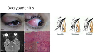 Clinical 5th Grade Dr Ahmed Osama Hashem Ophthalmology.pptx