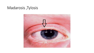 Clinical 5th Grade Dr Ahmed Osama Hashem Ophthalmology.pptx
