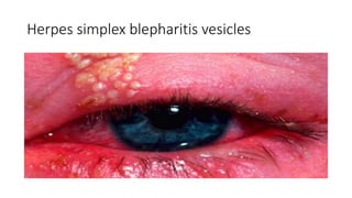 Clinical 5th Grade Dr Ahmed Osama Hashem Ophthalmology.pptx