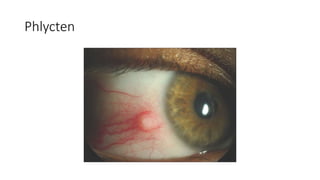 Clinical 5th Grade Dr Ahmed Osama Hashem Ophthalmology.pptx