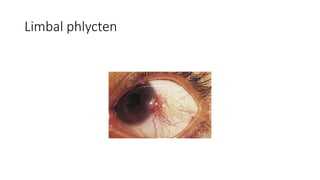 Clinical 5th Grade Dr Ahmed Osama Hashem Ophthalmology.pptx