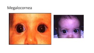 Clinical 5th Grade Dr Ahmed Osama Hashem Ophthalmology.pptx