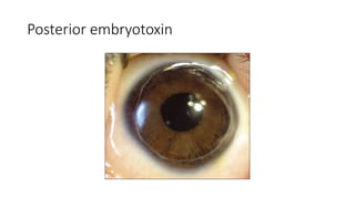 Clinical 5th Grade Dr Ahmed Osama Hashem Ophthalmology.pptx