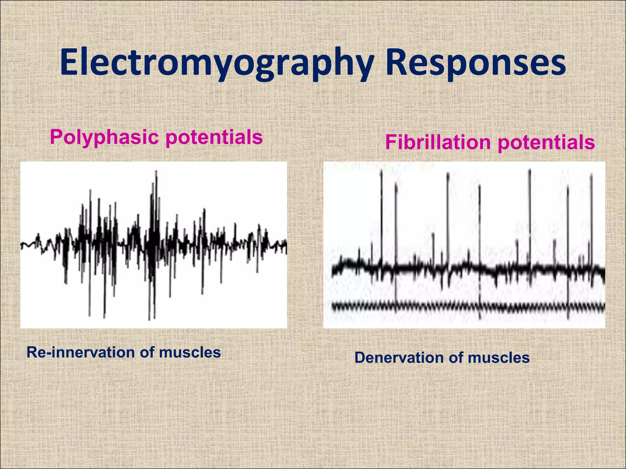 Clinical anatomy of facial nerve and facial nerve palsy | PPT