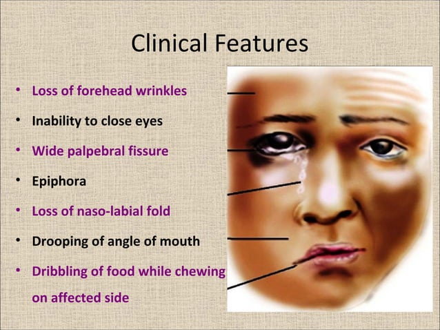 Clinical anatomy of facial nerve and facial nerve palsy | PPT