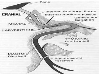 Clinical anatomy of facial nerve and facial nerve palsy | PPT