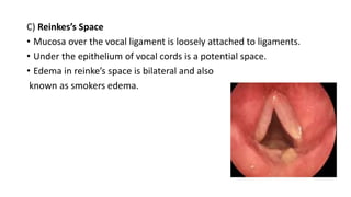 Clinical Anatomy Of Laryngeal Cancer.ppt