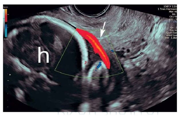 Clinical application of doppler in obstetrics new | PPTX | Pregnancy ...