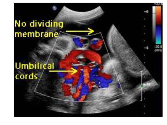 Clinical application of doppler in obstetrics new | PPTX | Pregnancy ...