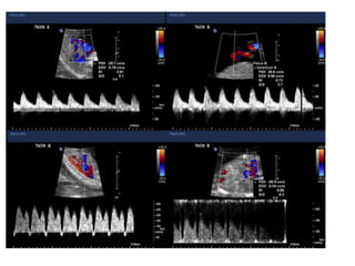 Clinical application of doppler in obstetrics new | PPTX