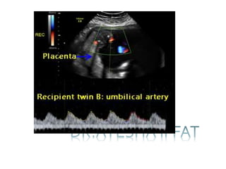 Clinical application of doppler in obstetrics new | PPTX