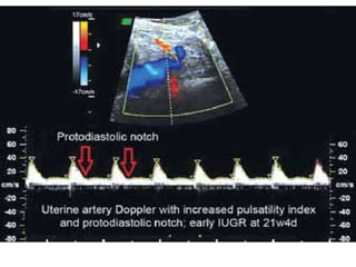 Clinical application of doppler in obstetrics new | PPTX