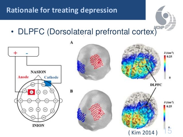 Dorsolateral Prefrontal Cortex Tdcs (PDF) Anodal TDCS To Right