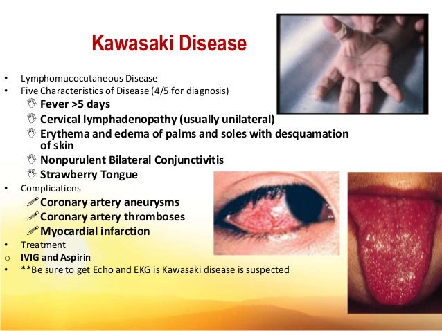 Clinical Approach Fever Lymphadenopathy