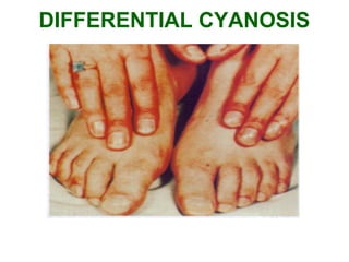 Clinical approach to congenital heart disease diagnosis | PPT