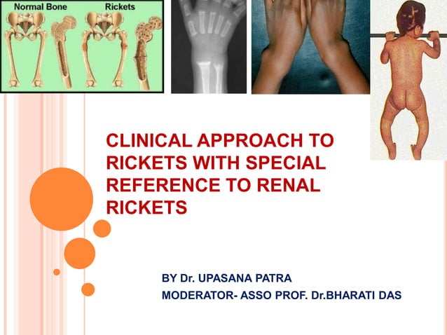 Clinical approach to rickets with special reference to renal rickets- by Dr upasana Patra | PPTX ...